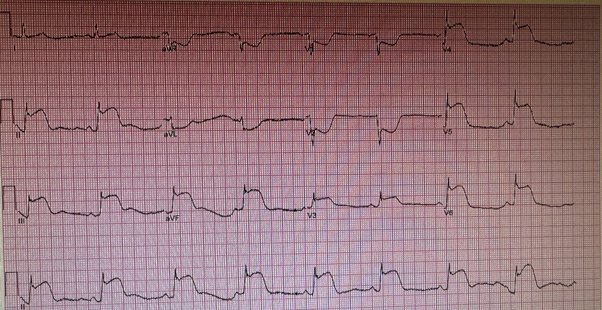 The Hyper Excited EKG – GlobeMedic