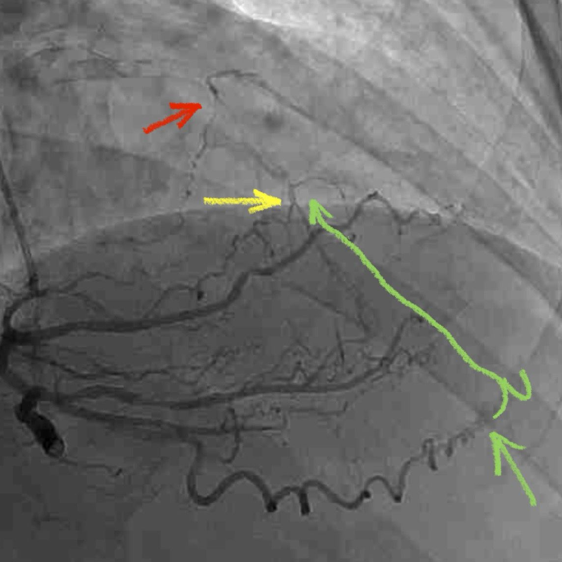A Tough Chronic Total Occlusion (CTO) – GlobeMedic